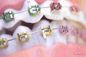 Los mejores colores de brackets: ¿Por cuáles optar? – Coomevasaludoral.com